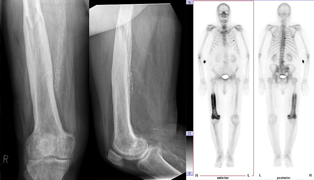 Pagets Disease Of Bone Modalities And Radiographic Appearance