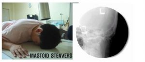 CE4RT - X-ray Positioning of the Mastoid Process for Radiologic Techs