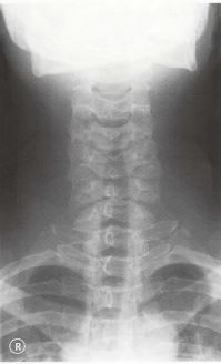 CE4RT - Radiographic Positioning of the Cervical Spine for X-ray Techs