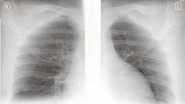 CE4RT - Radiographic Positioning of the Chest for X-ray Techs