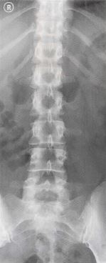 CE4RT - Radiographic Positioning of the Lumbar Spine for X-ray Techs