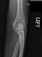 CE4RT - Radiographic Positioning of the Elbow for X-ray Technicians