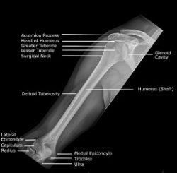 CE4RT - Radiographic Positioning of the Shoulder for X-ray Techs