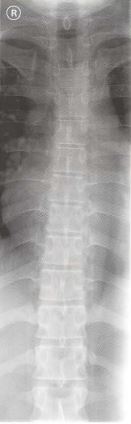 CE4RT - Radiographic Positioning of the Thoracic Spine for X-ray Techs