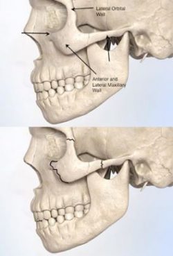 Zygomatic Arch - X-ray Tech Positioning Guide